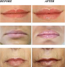 lip-b-and-a | Sibia Eye Institute